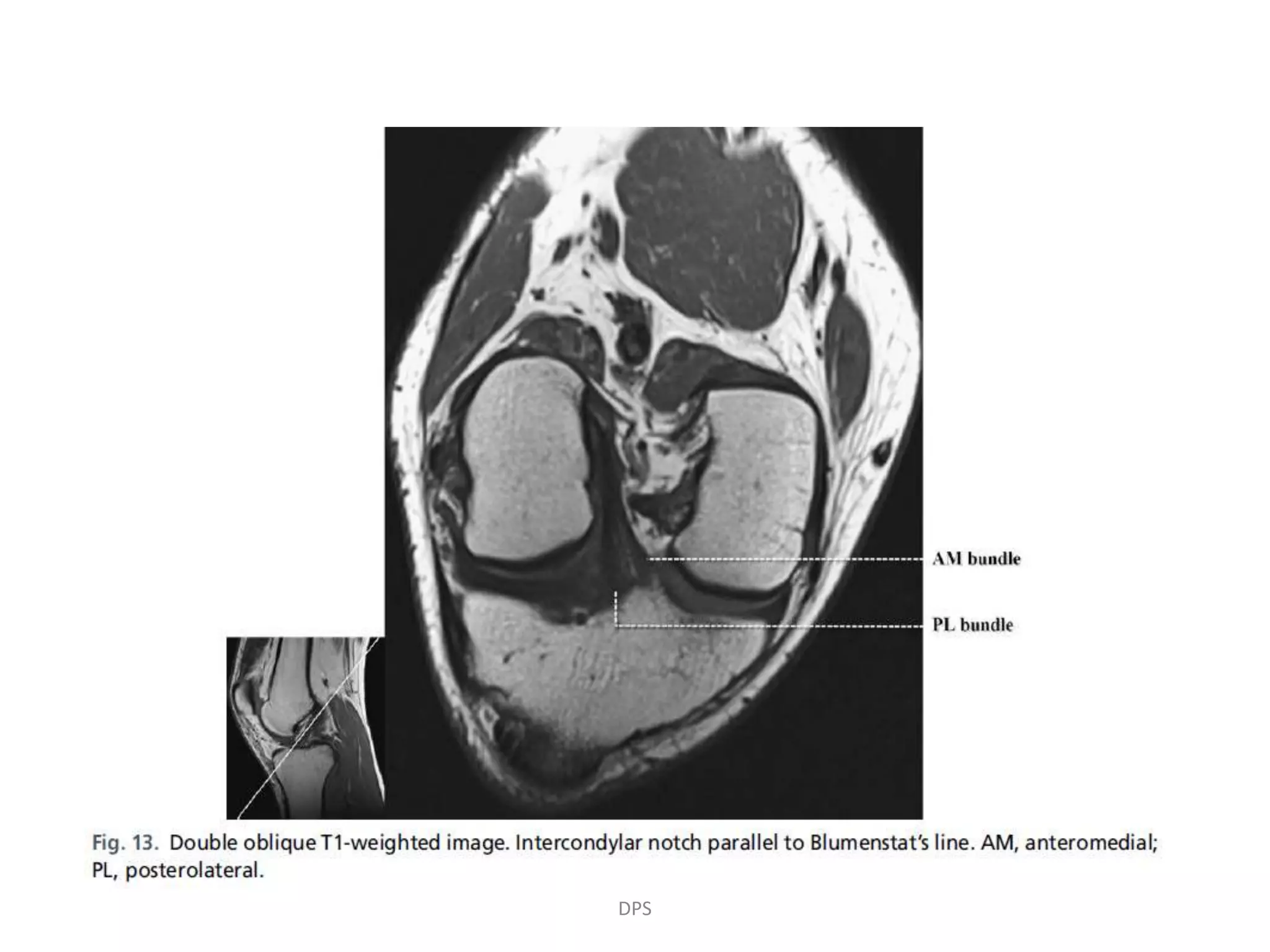 Knee Mri Systematic Interpretation By Dr D P Swami Ppt