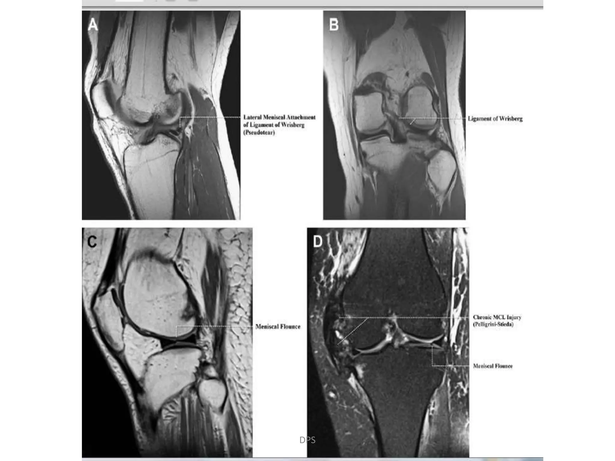 Knee mri: systematic interpretation by dr. d. p. swami | PPTX | Death, Injury, or Military ...