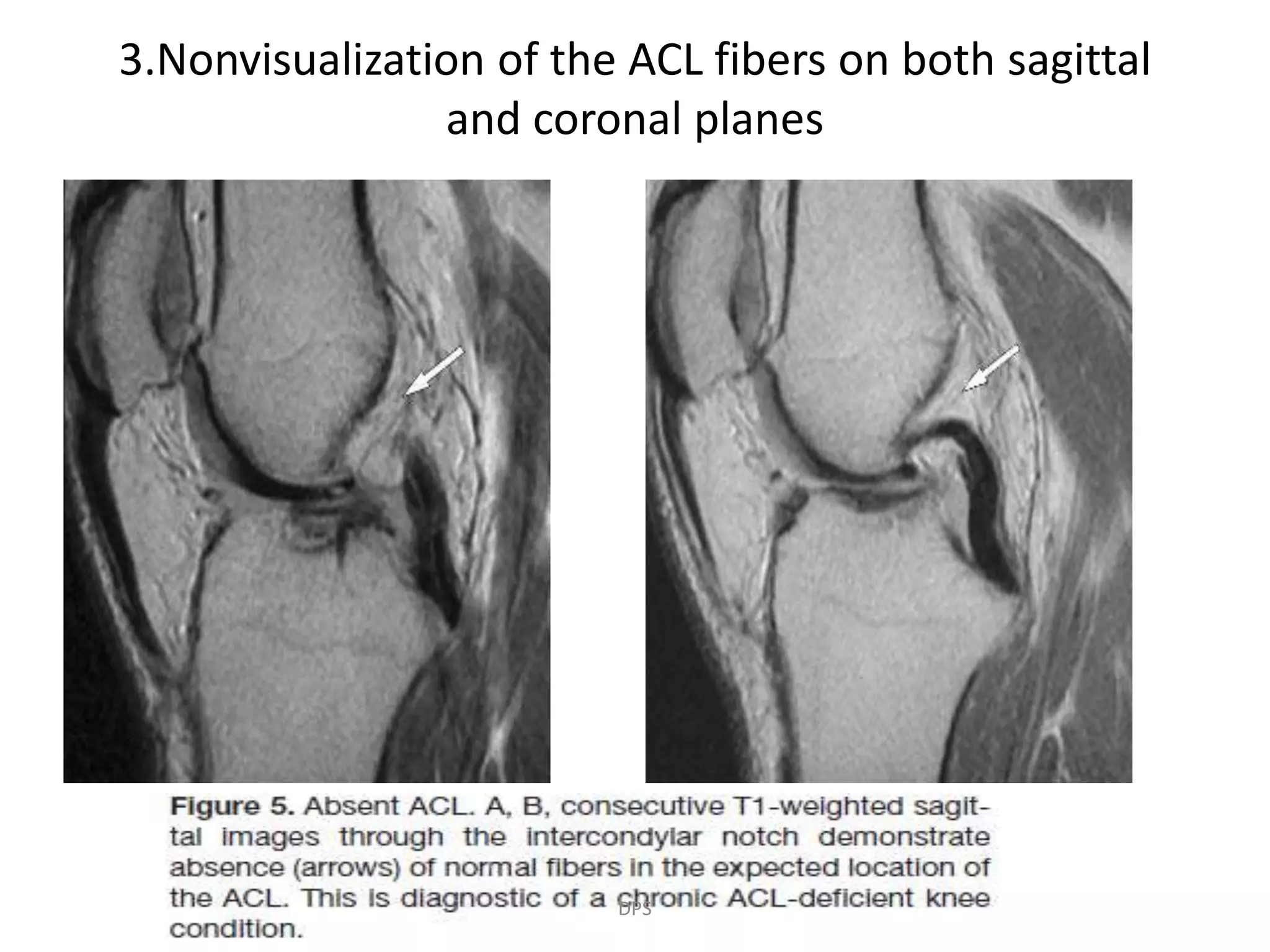 Knee mri: systematic interpretation by dr. d. p. swami | PPTX | Death, Injury, or Military ...