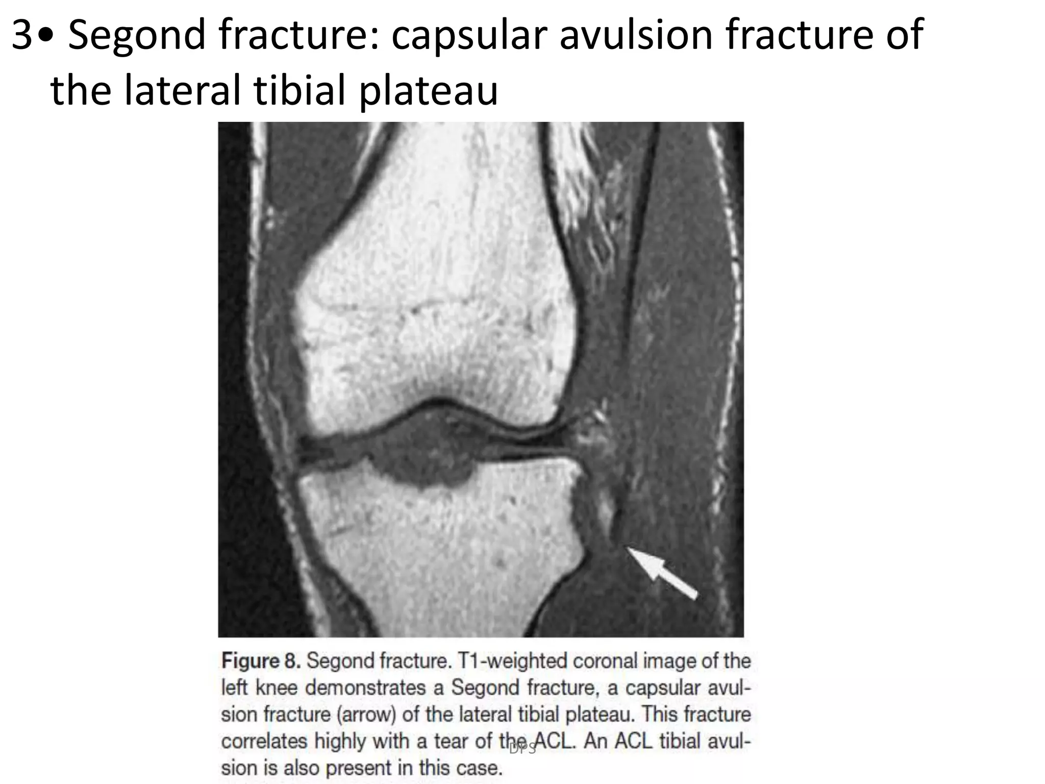 Knee mri: systematic interpretation by dr. d. p. swami | PPTX | Death, Injury, or Military ...