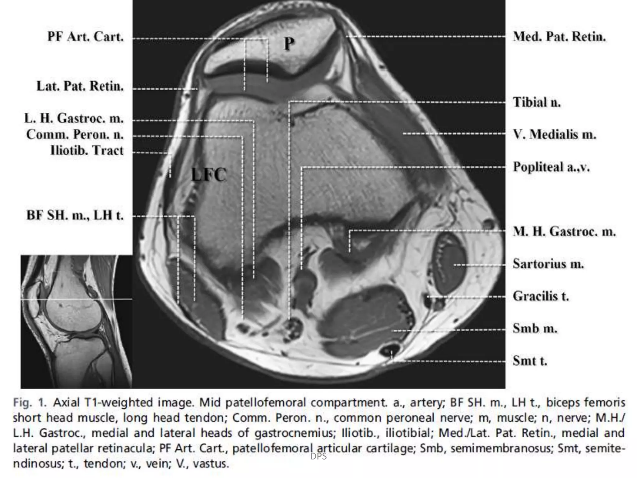 Knee mri: systematic interpretation by dr. d. p. swami | PPTX