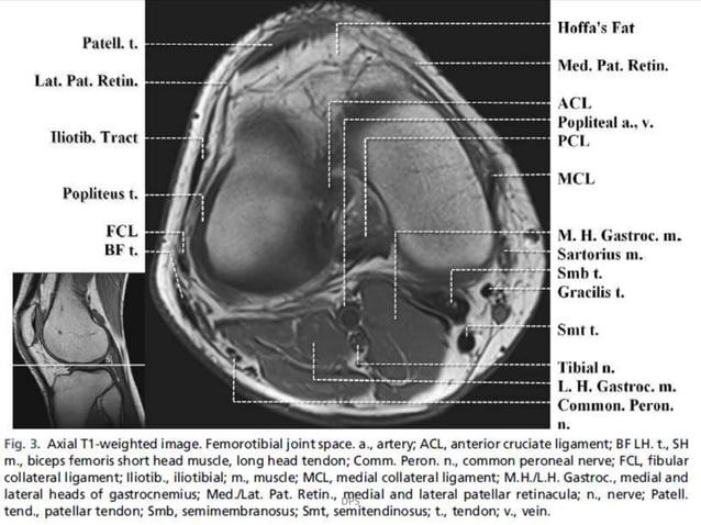 Knee mri: systematic interpretation by dr. d. p. swami | PPTX | Death, Injury, or Military ...