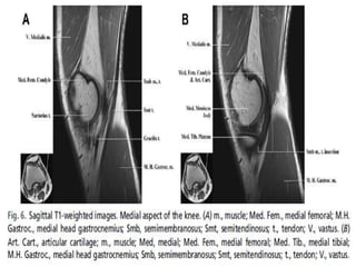 Knee mri: systematic interpretation by dr. d. p. swami | PPTX