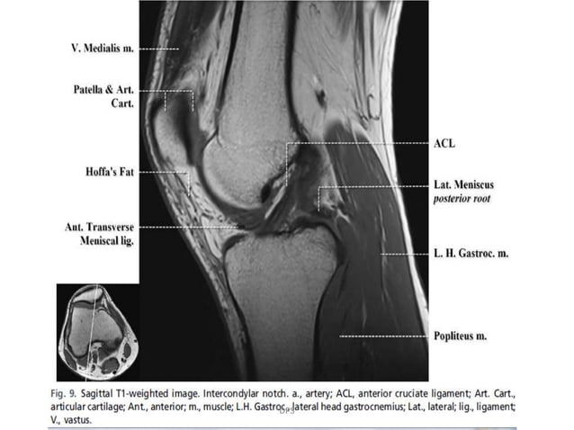 Knee mri: systematic interpretation by dr. d. p. swami | PPTX | Death, Injury, or Military ...