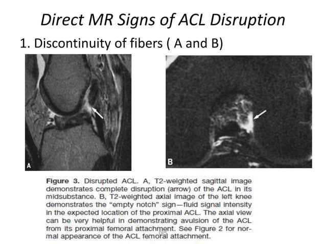 Knee mri: systematic interpretation by dr. d. p. swami | PPTX | Death, Injury, or Military ...