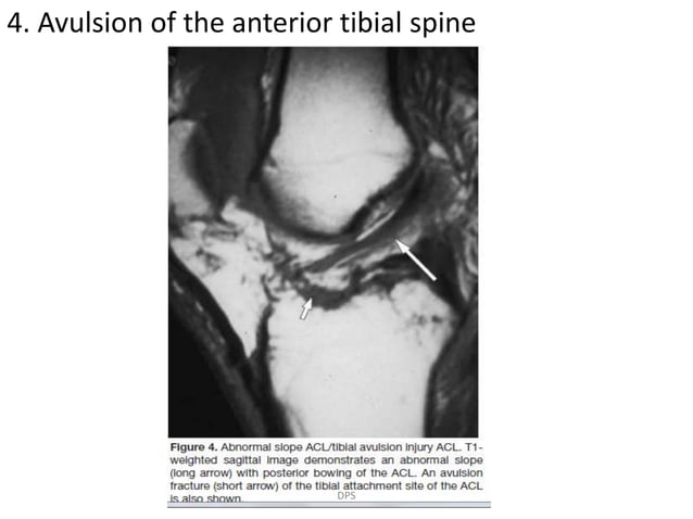 Knee mri: systematic interpretation by dr. d. p. swami | PPTX | Death, Injury, or Military ...