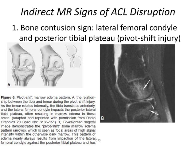 Knee mri: systematic interpretation by dr. d. p. swami | PPTX | Death, Injury, or Military ...
