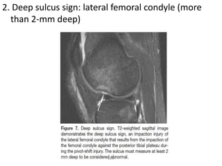 Knee mri: systematic interpretation by dr. d. p. swami | PPTX