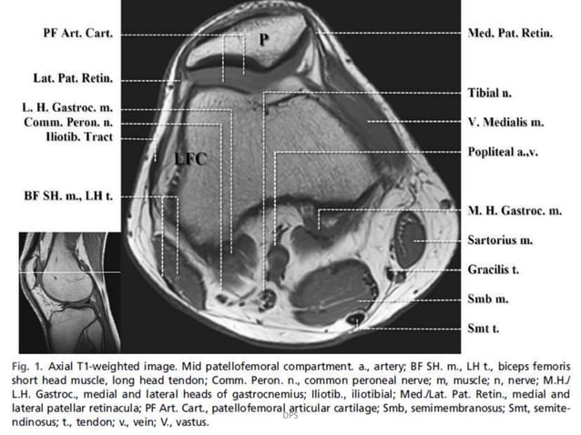 Knee mri: systematic interpretation by dr. d. p. swami | PPTX | Death, Injury, or Military ...