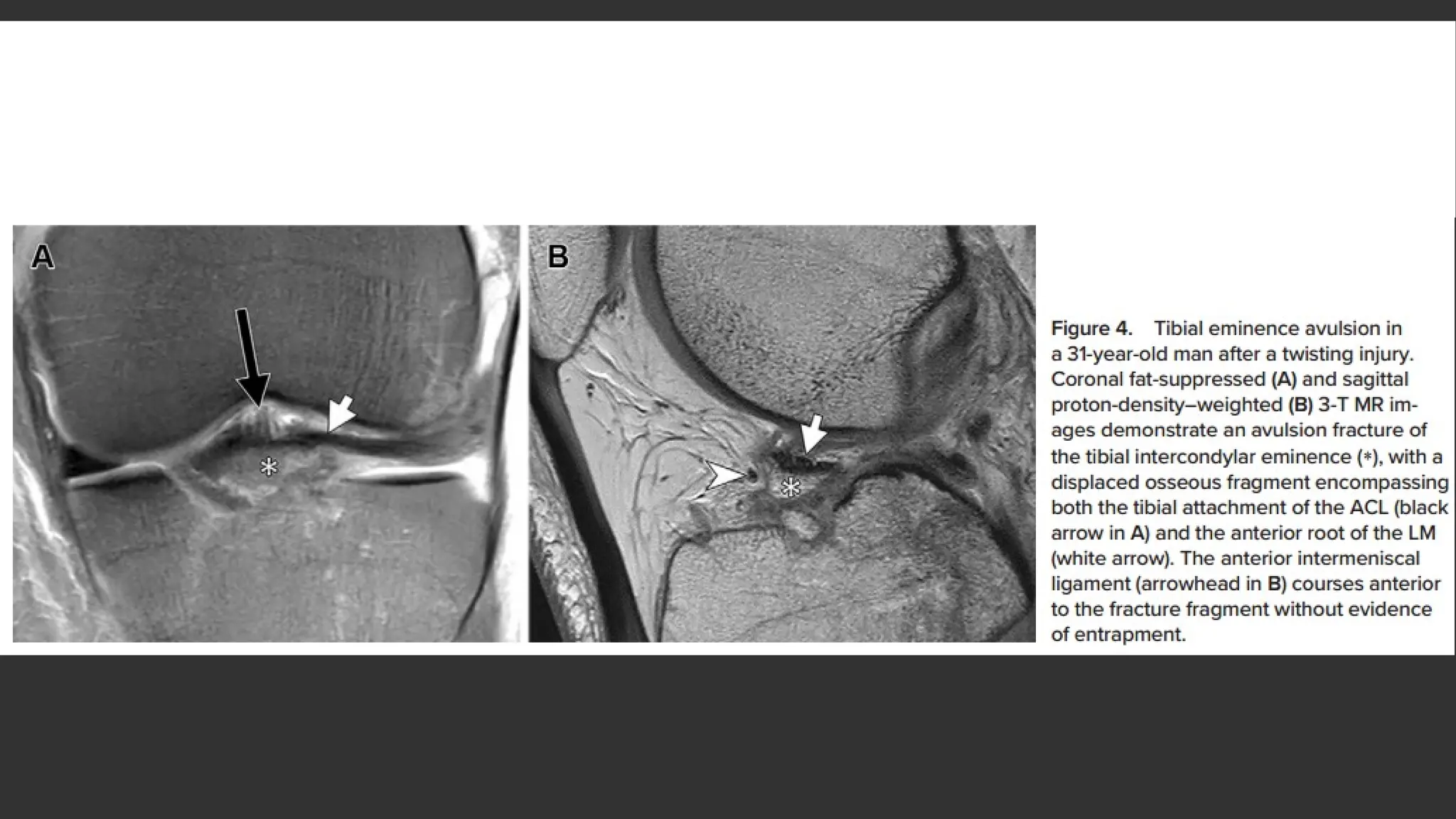 Knee MRI of meniscal injuries of knee joint.pptx
