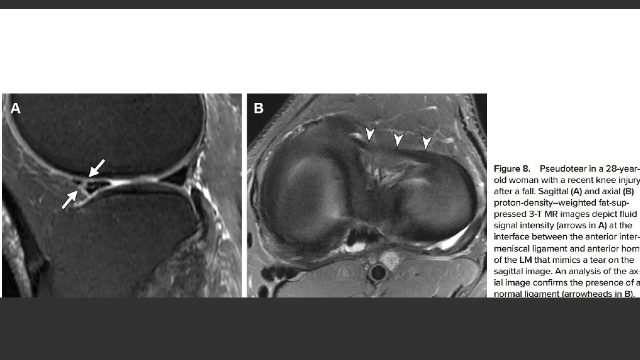 Knee MRI of meniscal injuries of knee joint.pptx