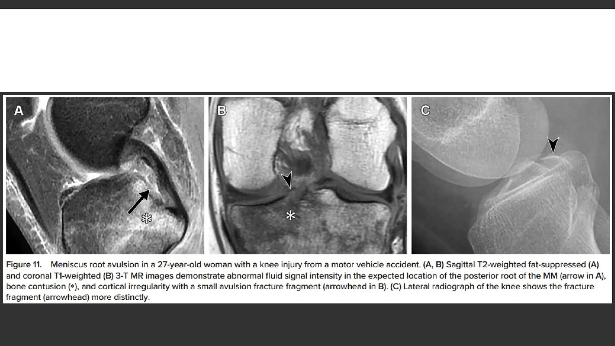 Knee MRI of meniscal injuries of knee joint.pptx