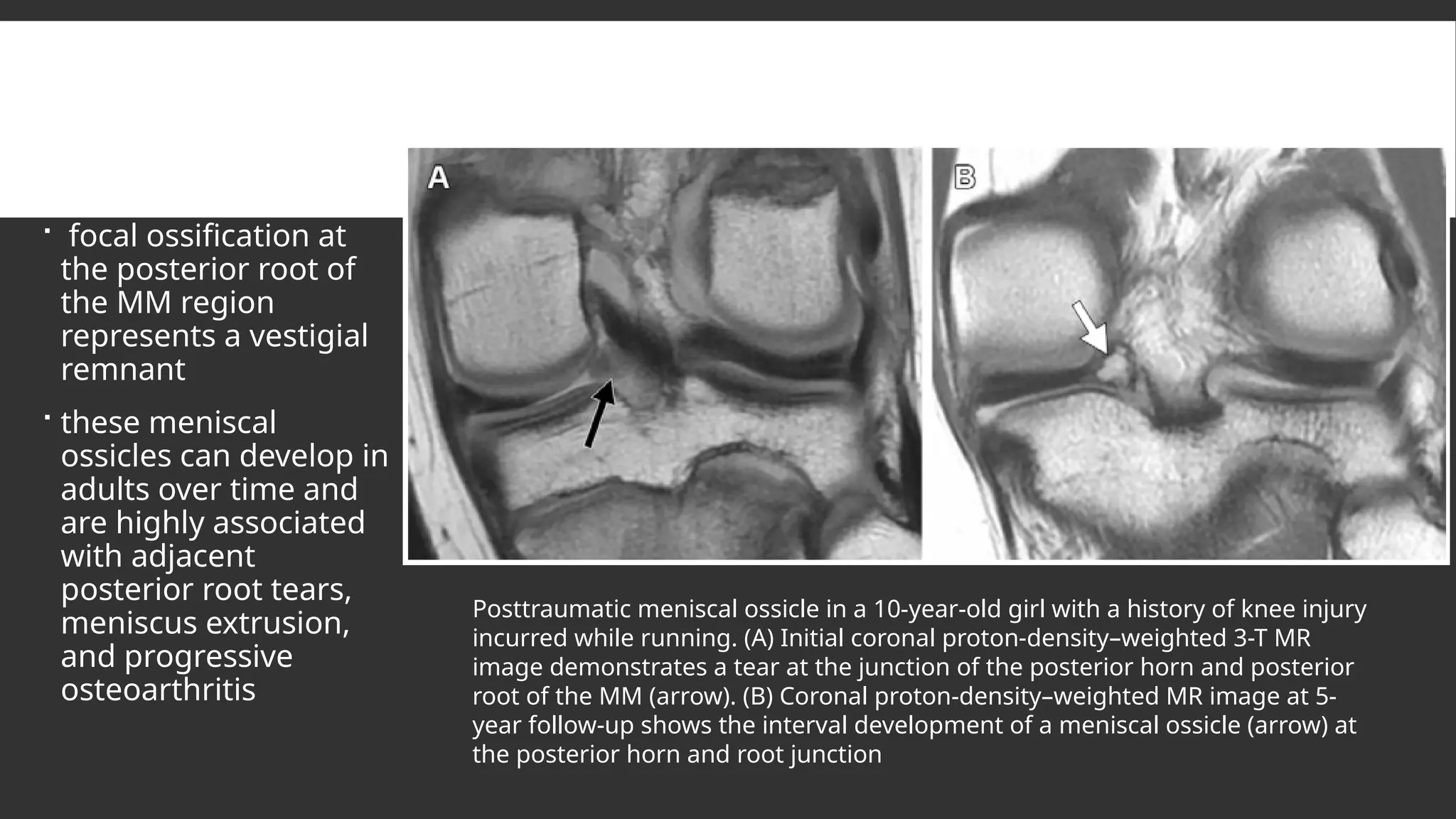 Knee MRI of meniscal injuries of knee joint.pptx