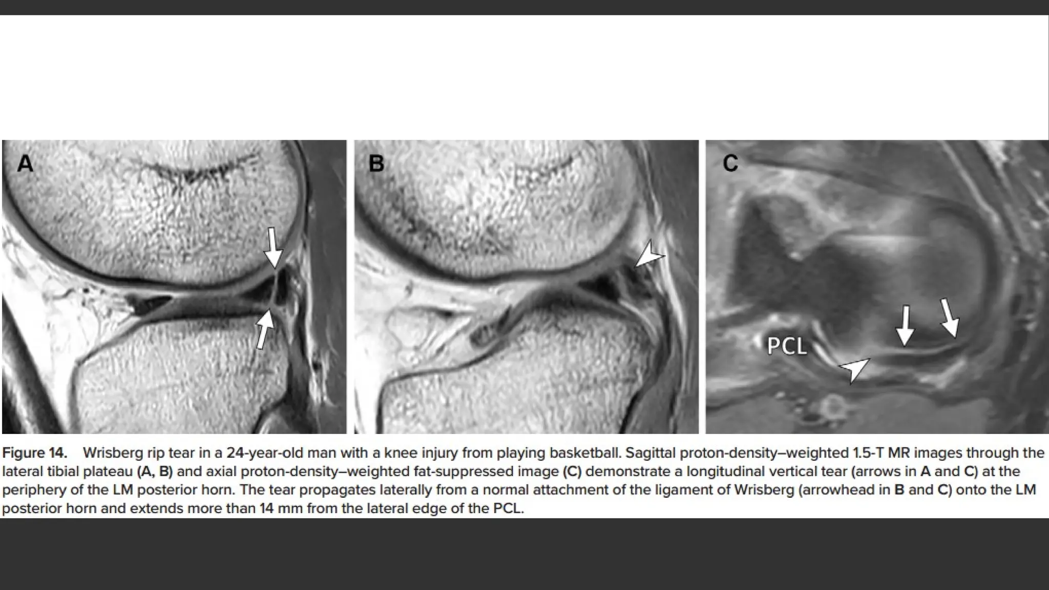 Knee MRI of meniscal injuries of knee joint.pptx