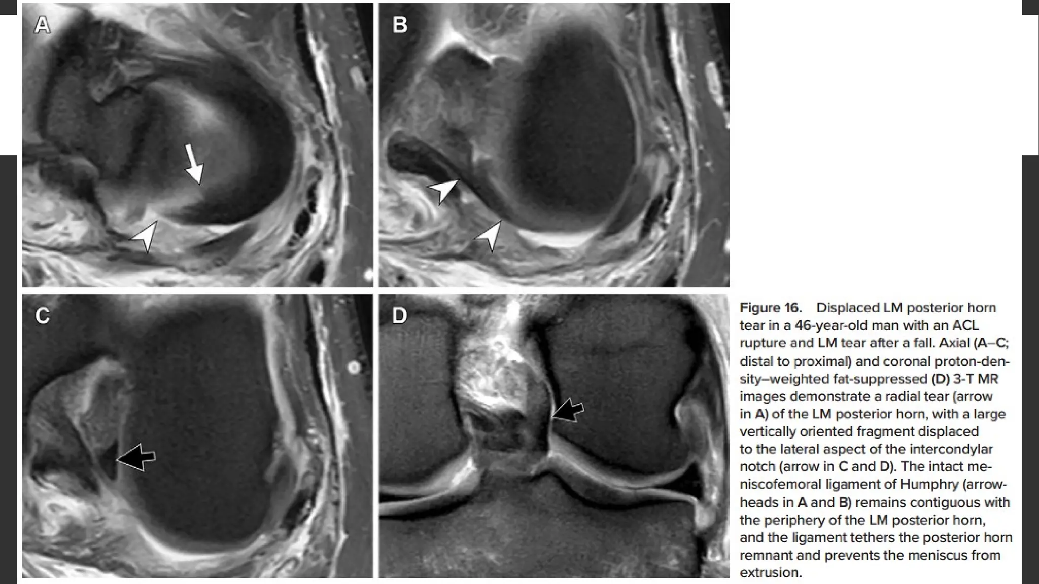 Knee MRI of meniscal injuries of knee joint.pptx
