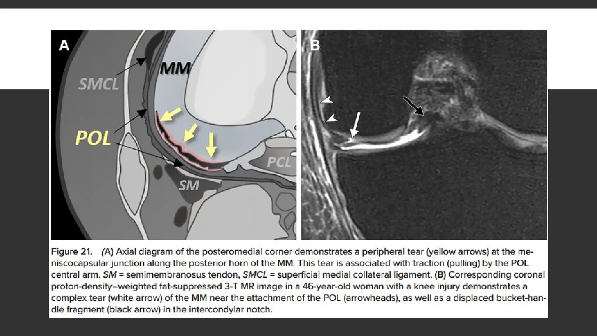 Knee MRI of meniscal injuries of knee joint.pptx
