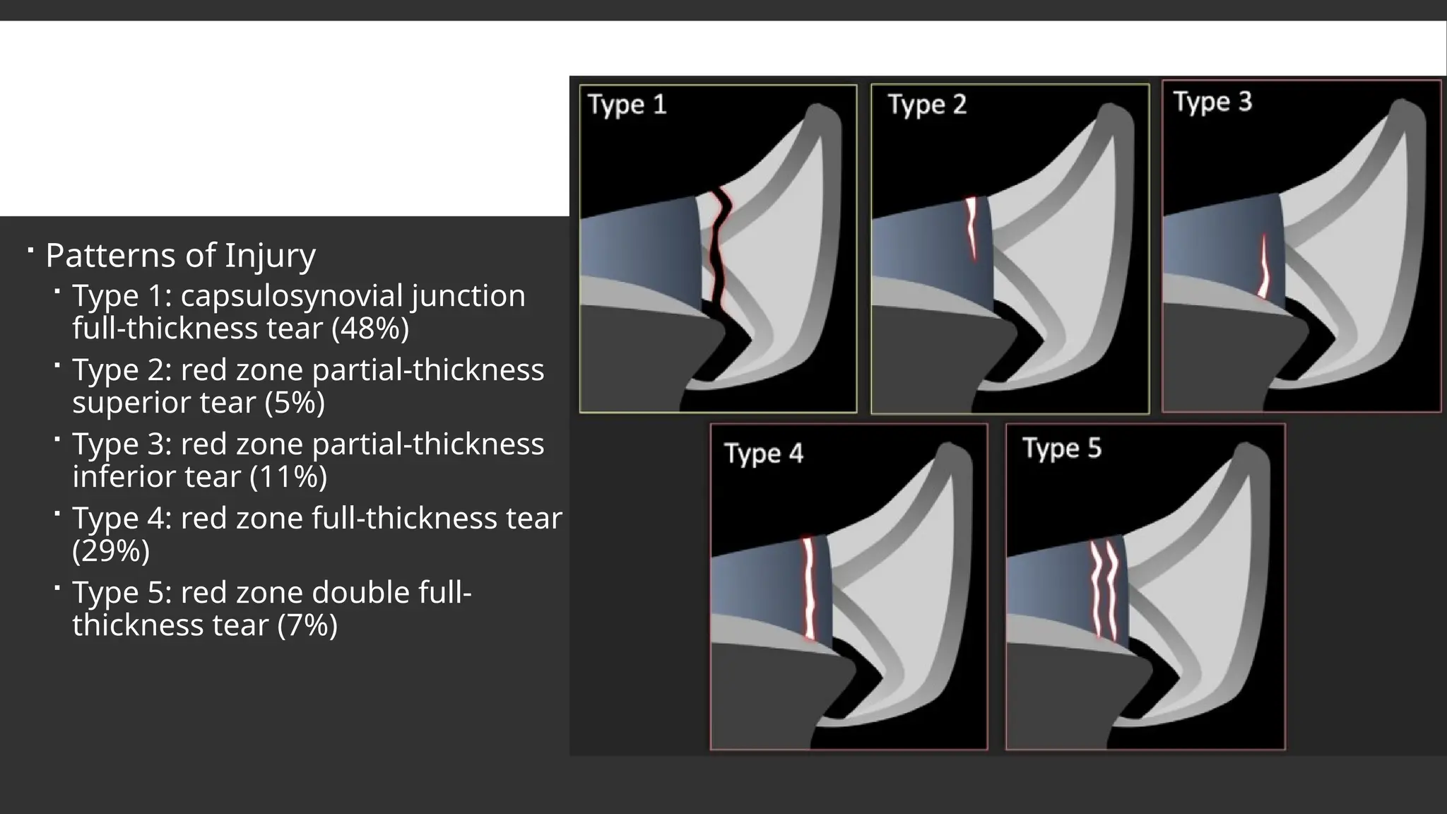 Knee MRI of meniscal injuries of knee joint.pptx