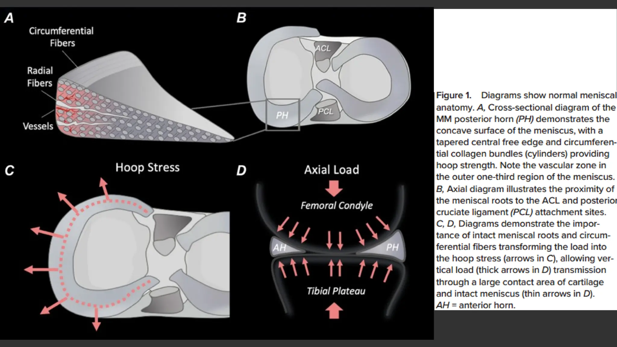 Knee MRI of meniscal injuries of knee joint.pptx