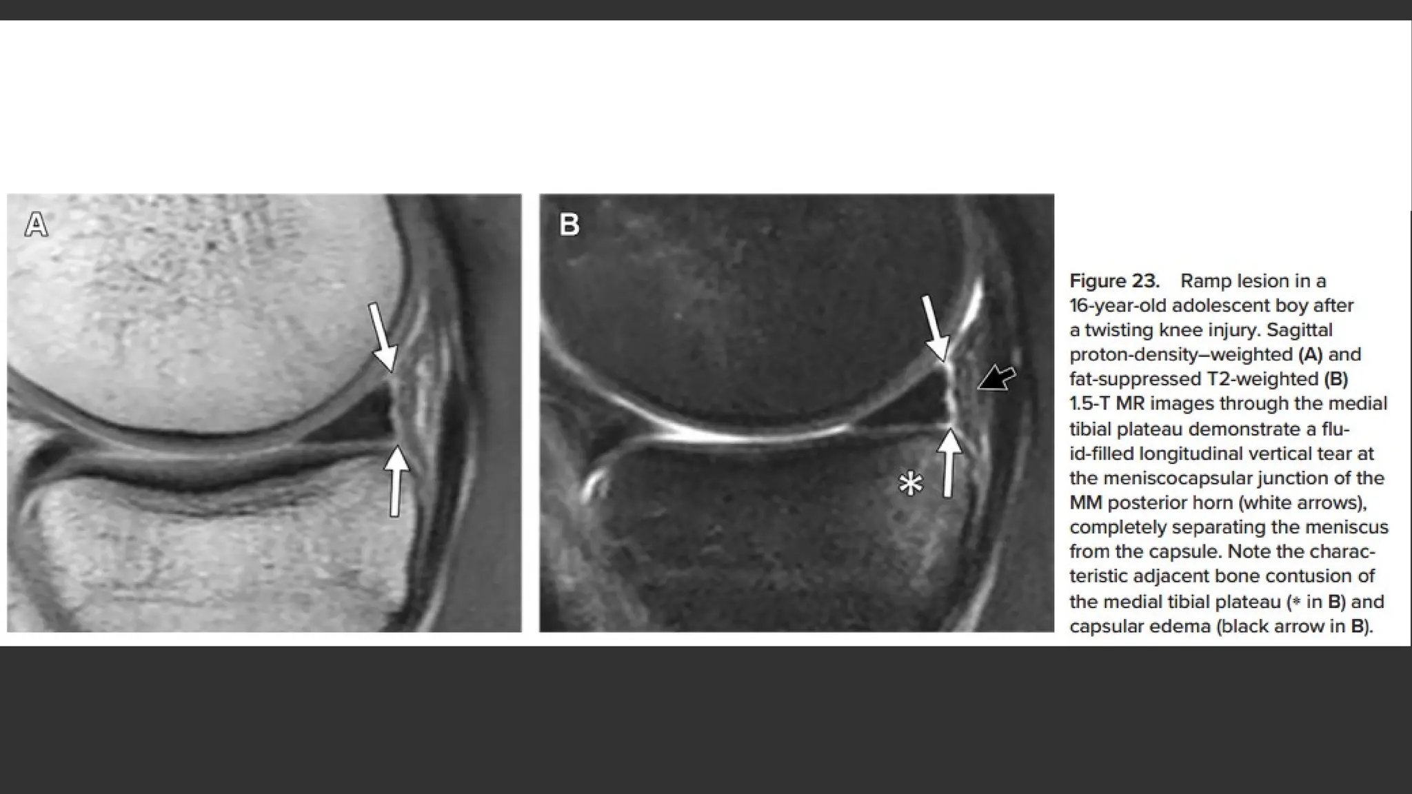 Knee MRI of meniscal injuries of knee joint.pptx