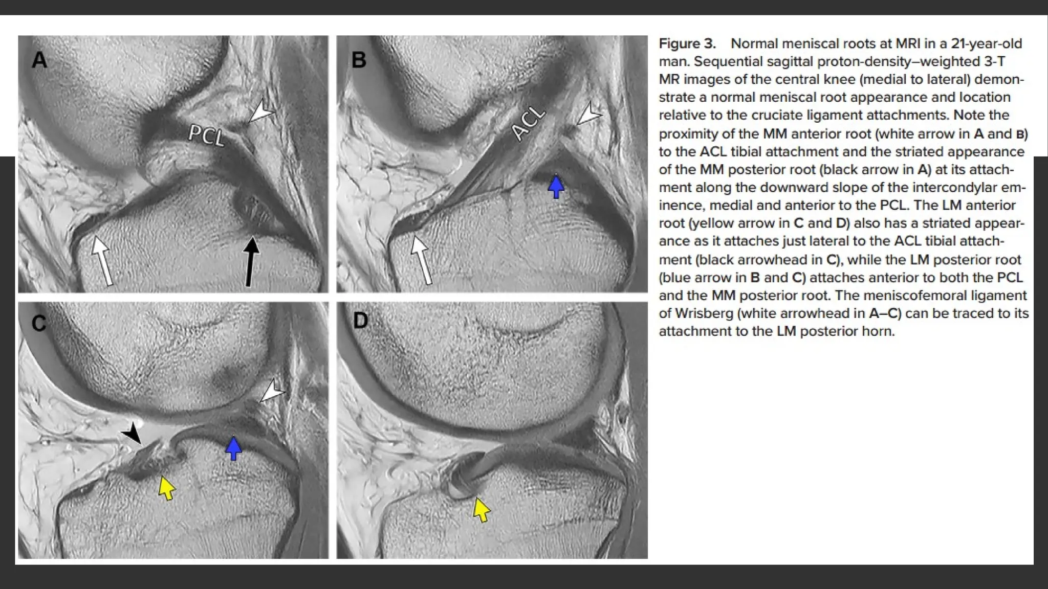 Knee MRI of meniscal injuries of knee joint.pptx