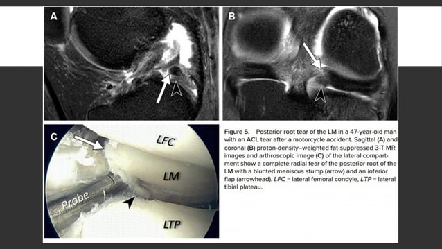Knee MRI of meniscal injuries of knee joint.pptx