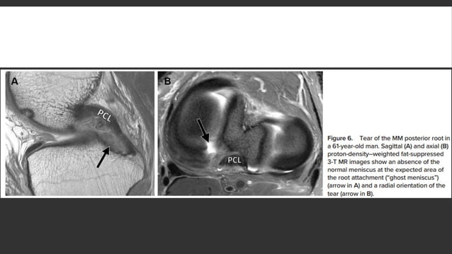 Knee MRI of meniscal injuries of knee joint.pptx