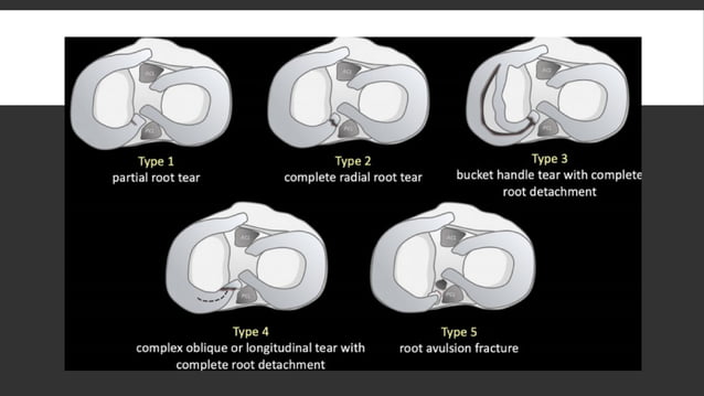 Knee MRI of meniscal injuries of knee joint.pptx