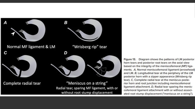 Knee MRI of meniscal injuries of knee joint.pptx