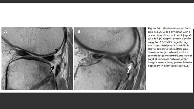 Knee MRI of meniscal injuries of knee joint.pptx