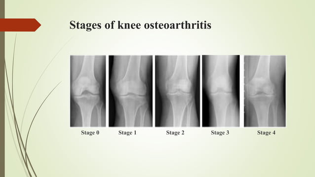 detection and classification of knee osteoarthritis.pptx | Bone and ...