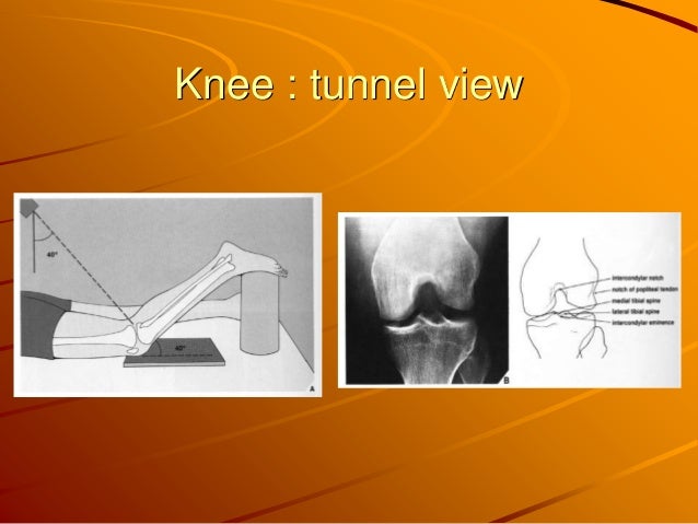 Knee osteoarthritis basics to reconstruction to replacement dr.sande…