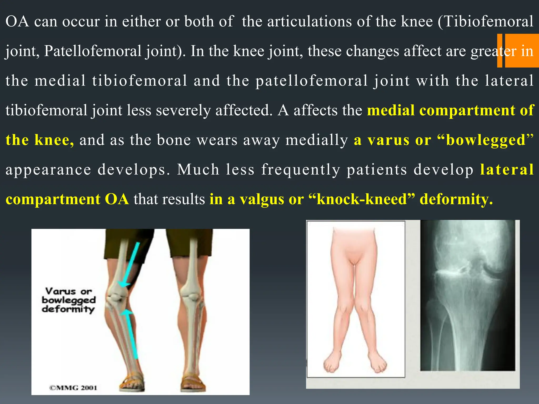 KNEE OSTEOARTHRITIS 2020-2021 orthopaedic rehabilitation.pdf