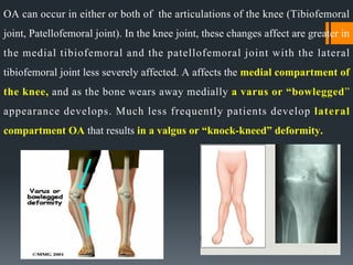 KNEE OSTEOARTHRITIS 2020-2021 orthopaedic rehabilitation.pdf
