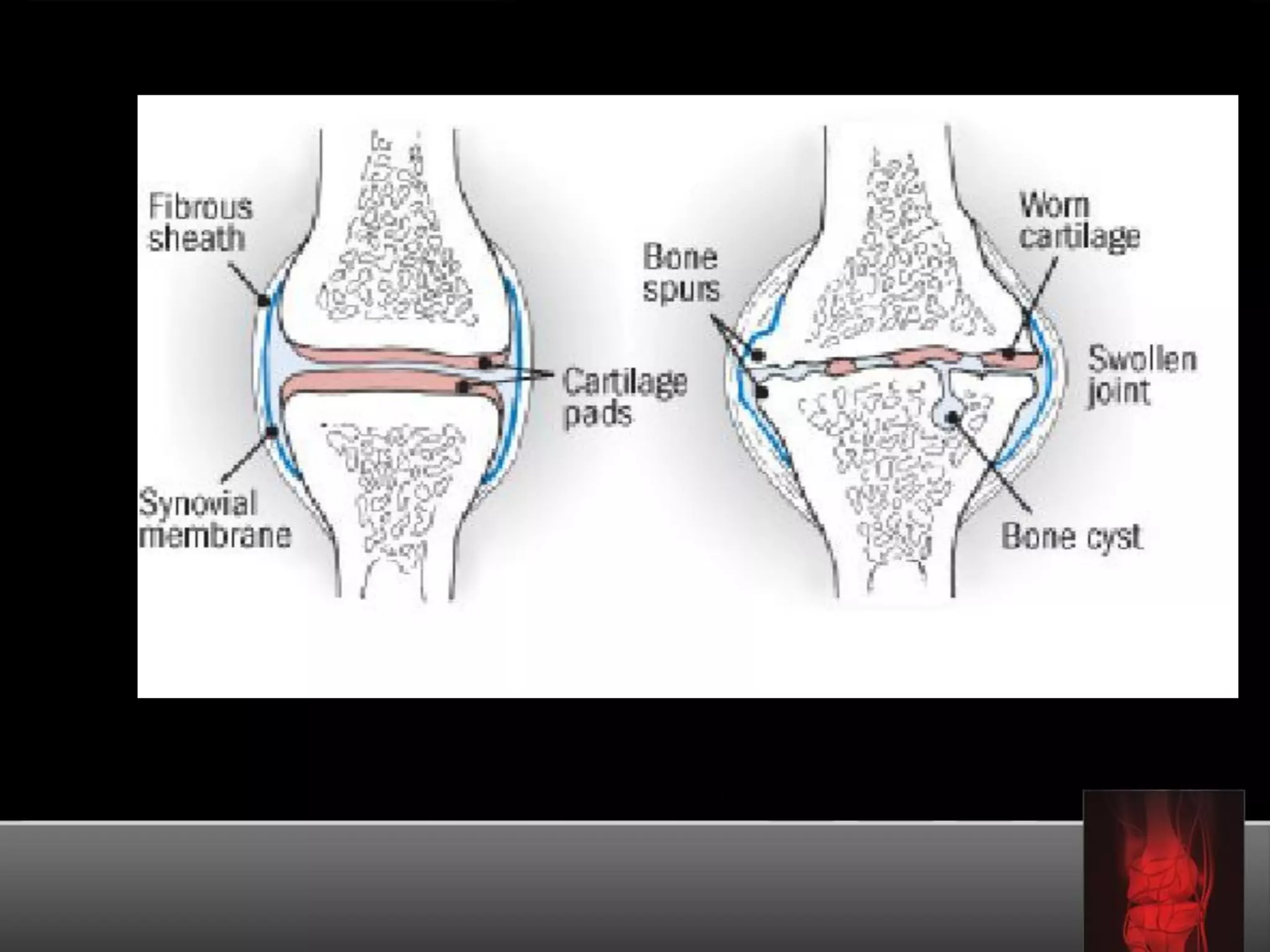 Knee osteoarthritis & its physiotherapeutic approaches | PDF