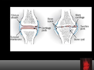 Knee osteoarthritis & its physiotherapeutic approaches | PDF