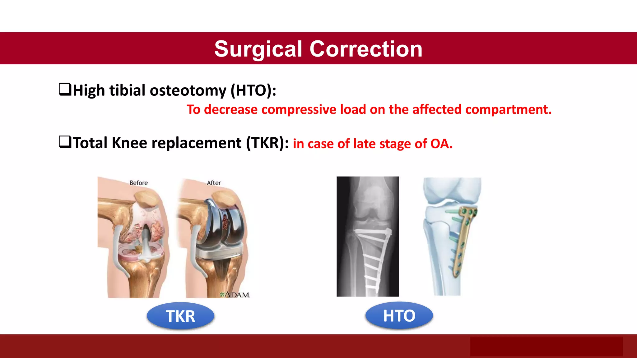Knee osteoarthritis treatment in 2019 | PPTX