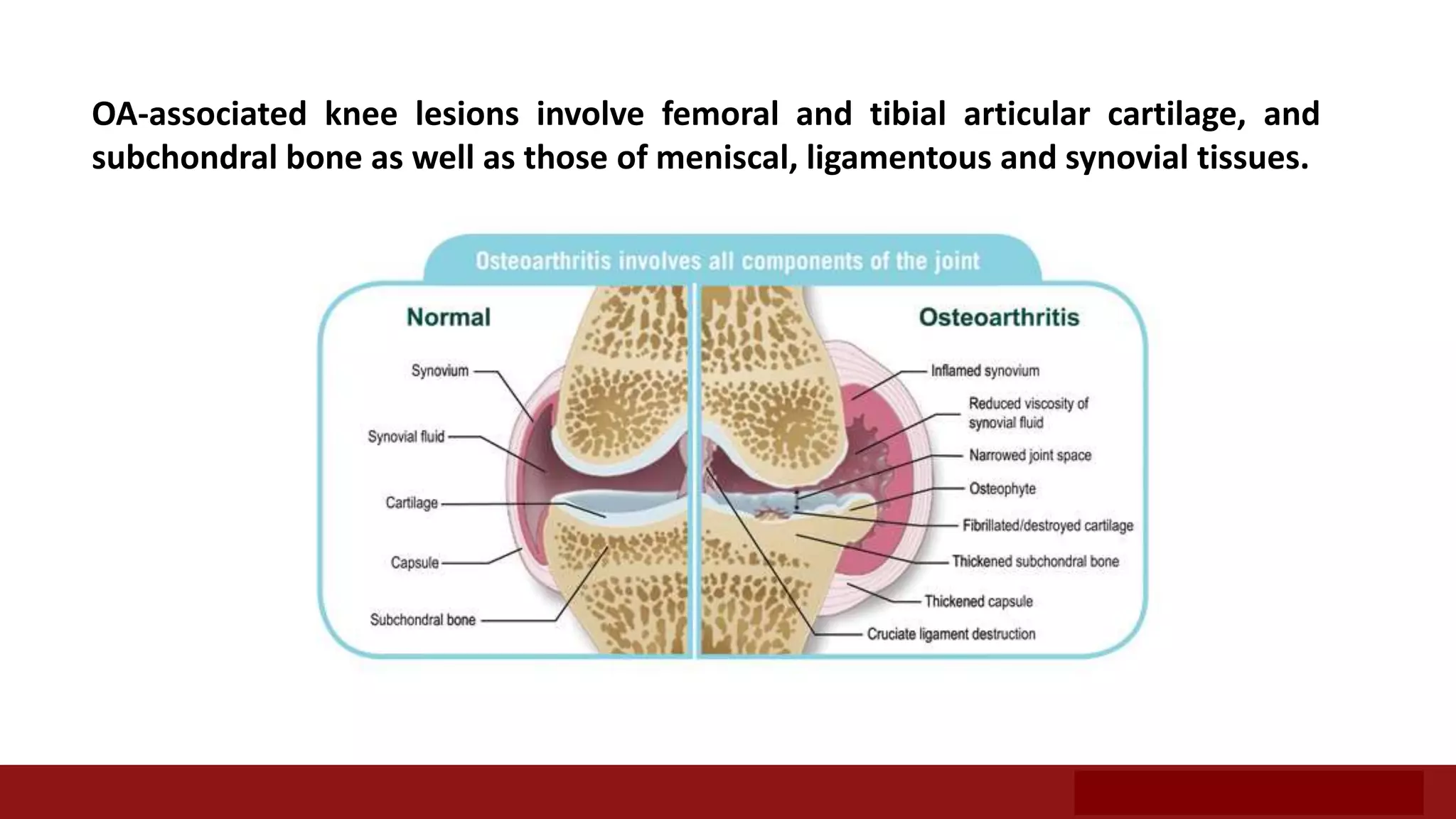 Knee osteoarthritis treatment in 2019 | PPTX