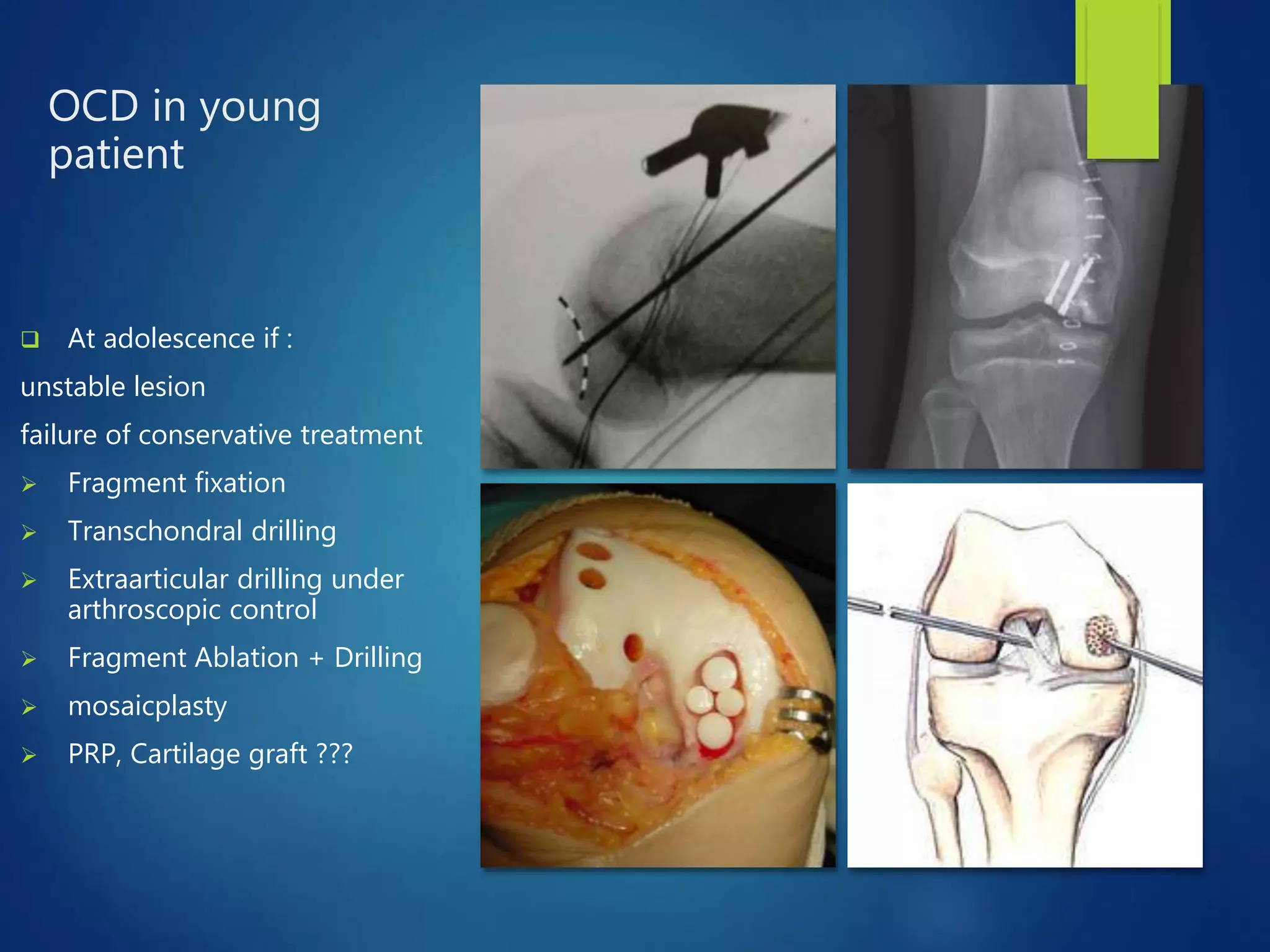 Knee osteochondritis and platelet rich plasma | PPTX