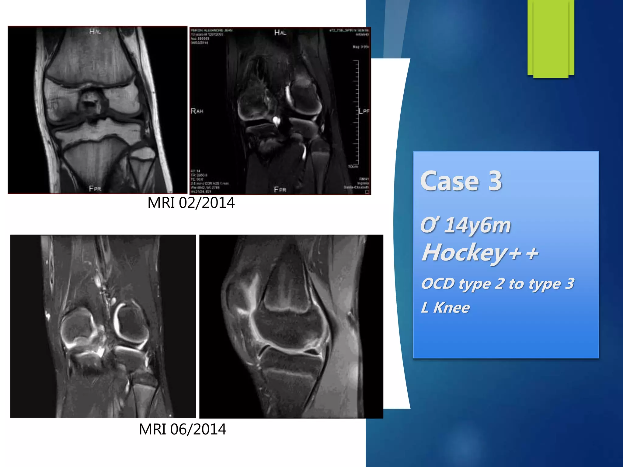 Knee osteochondritis and platelet rich plasma | PPTX
