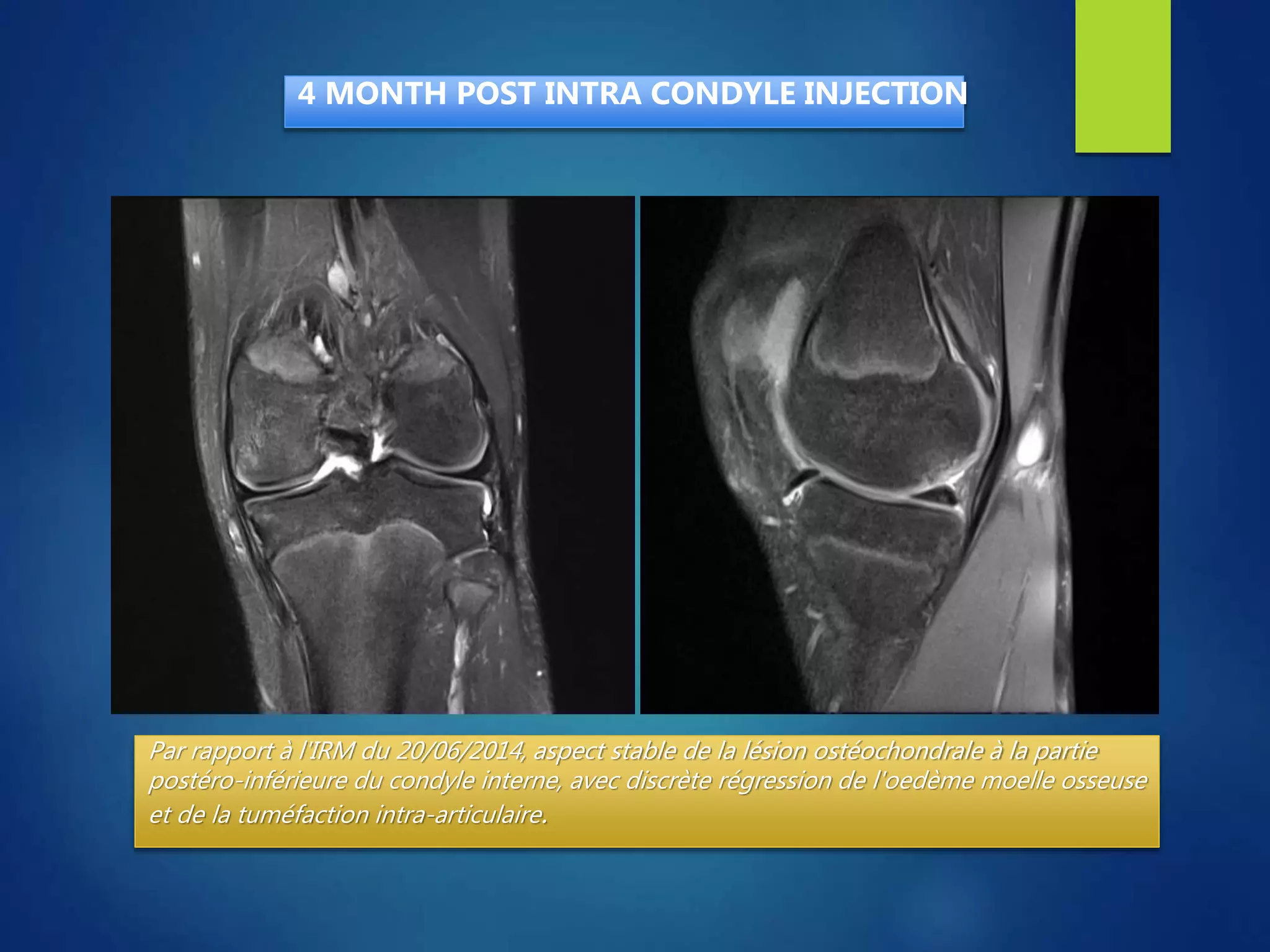 Knee osteochondritis and platelet rich plasma | PPTX