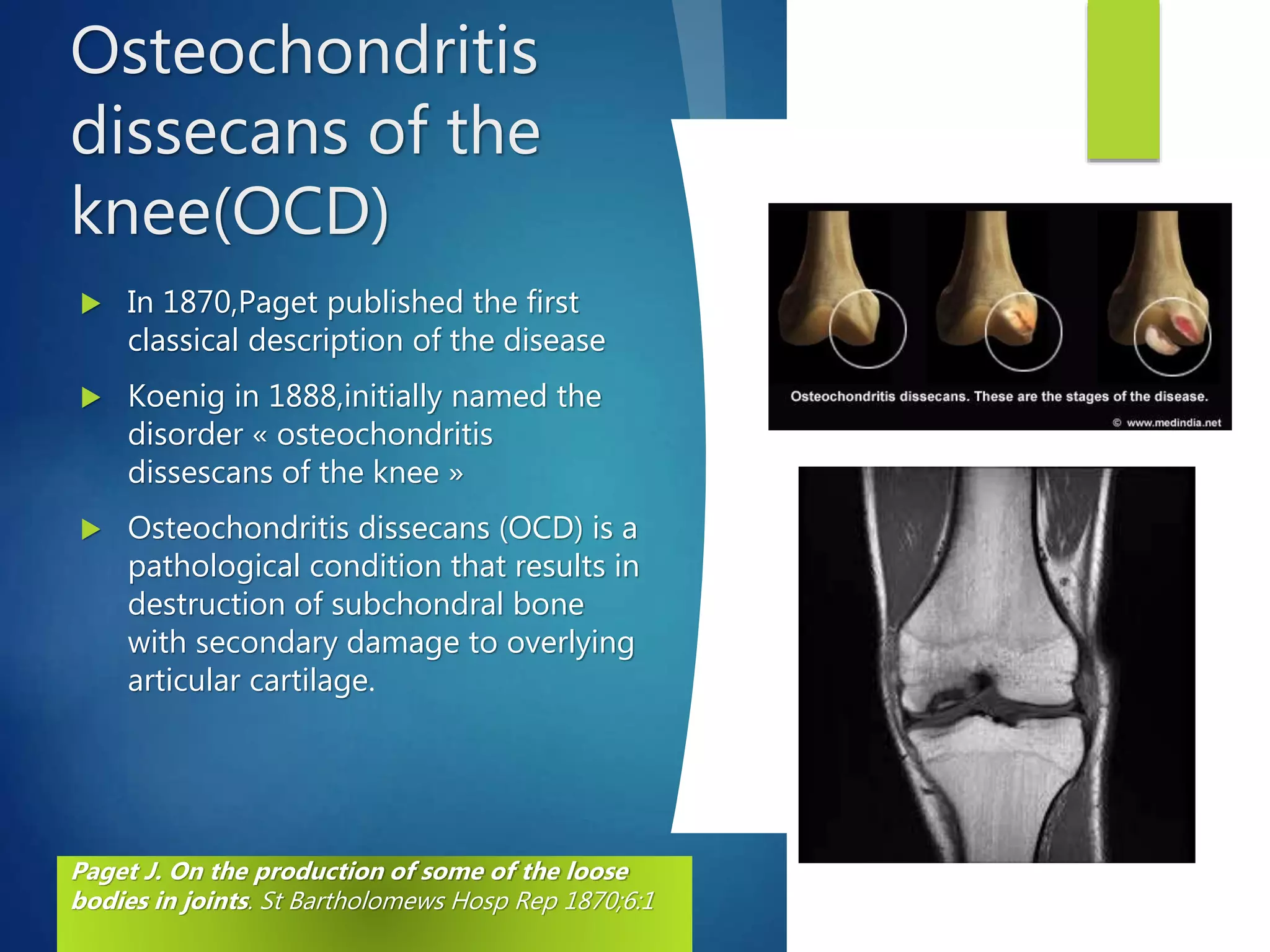 Knee osteochondritis and platelet rich plasma | PPTX