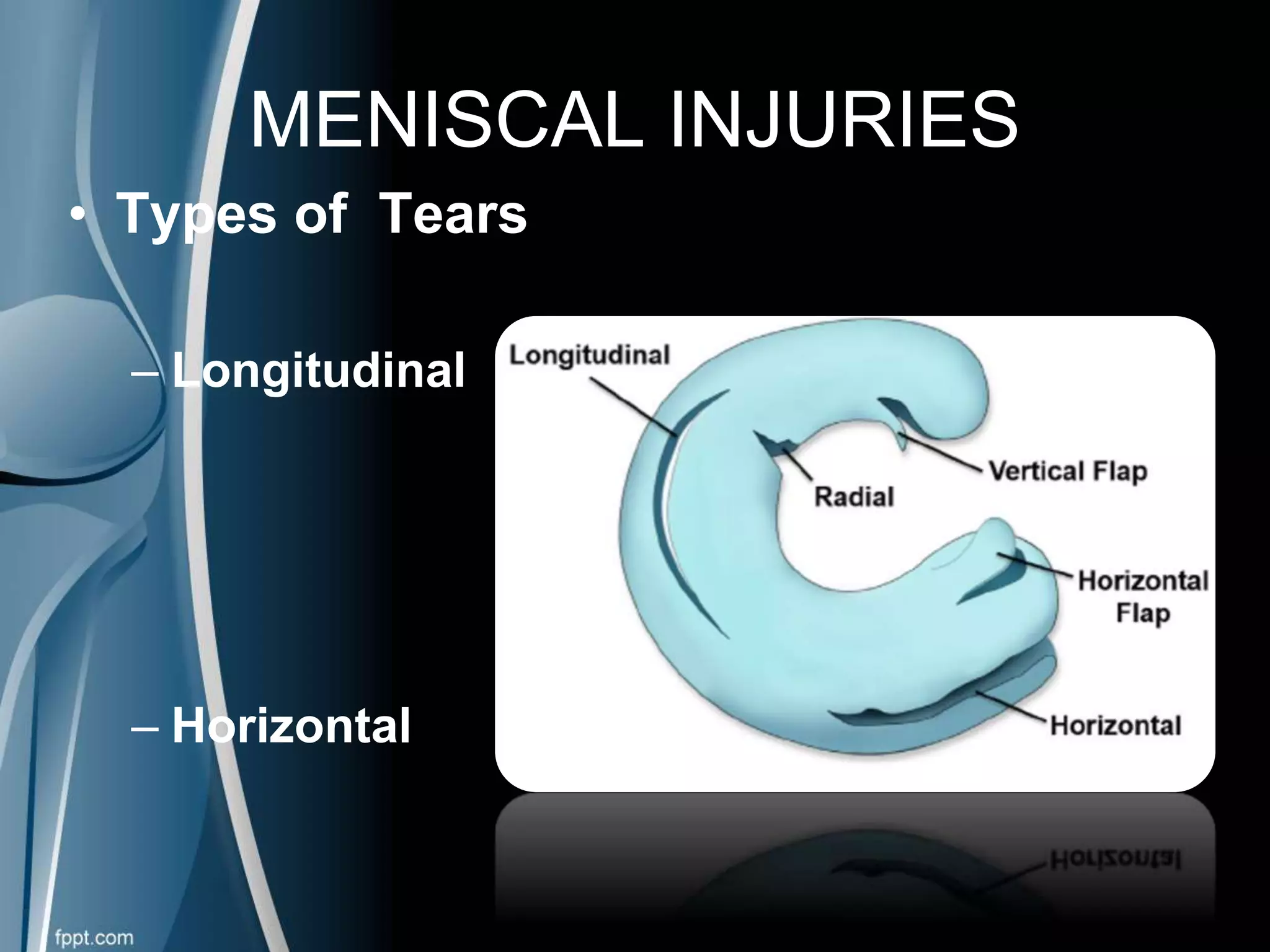 Meniscal Injuries | PPTX