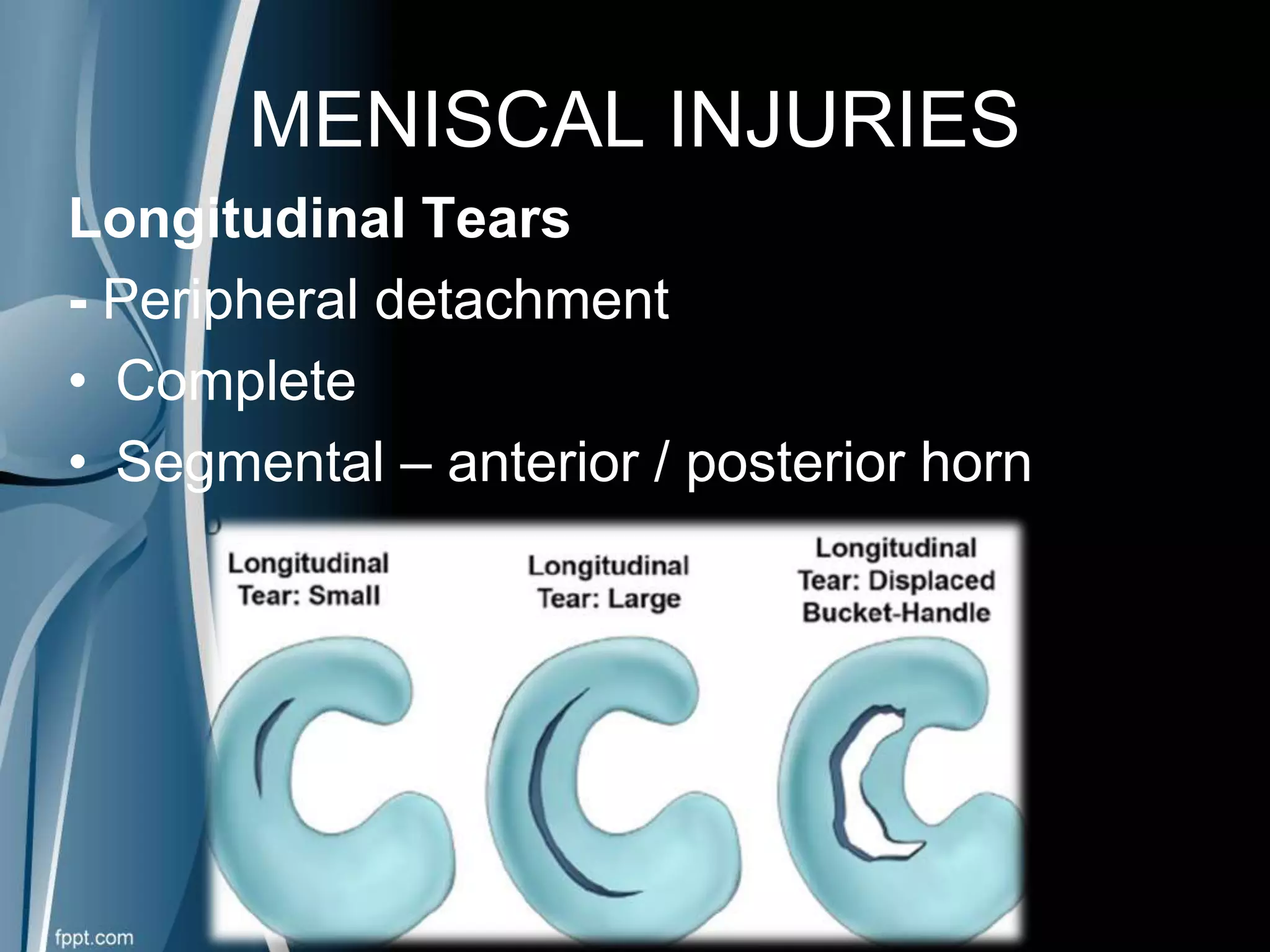 Meniscal Injuries | PPTX