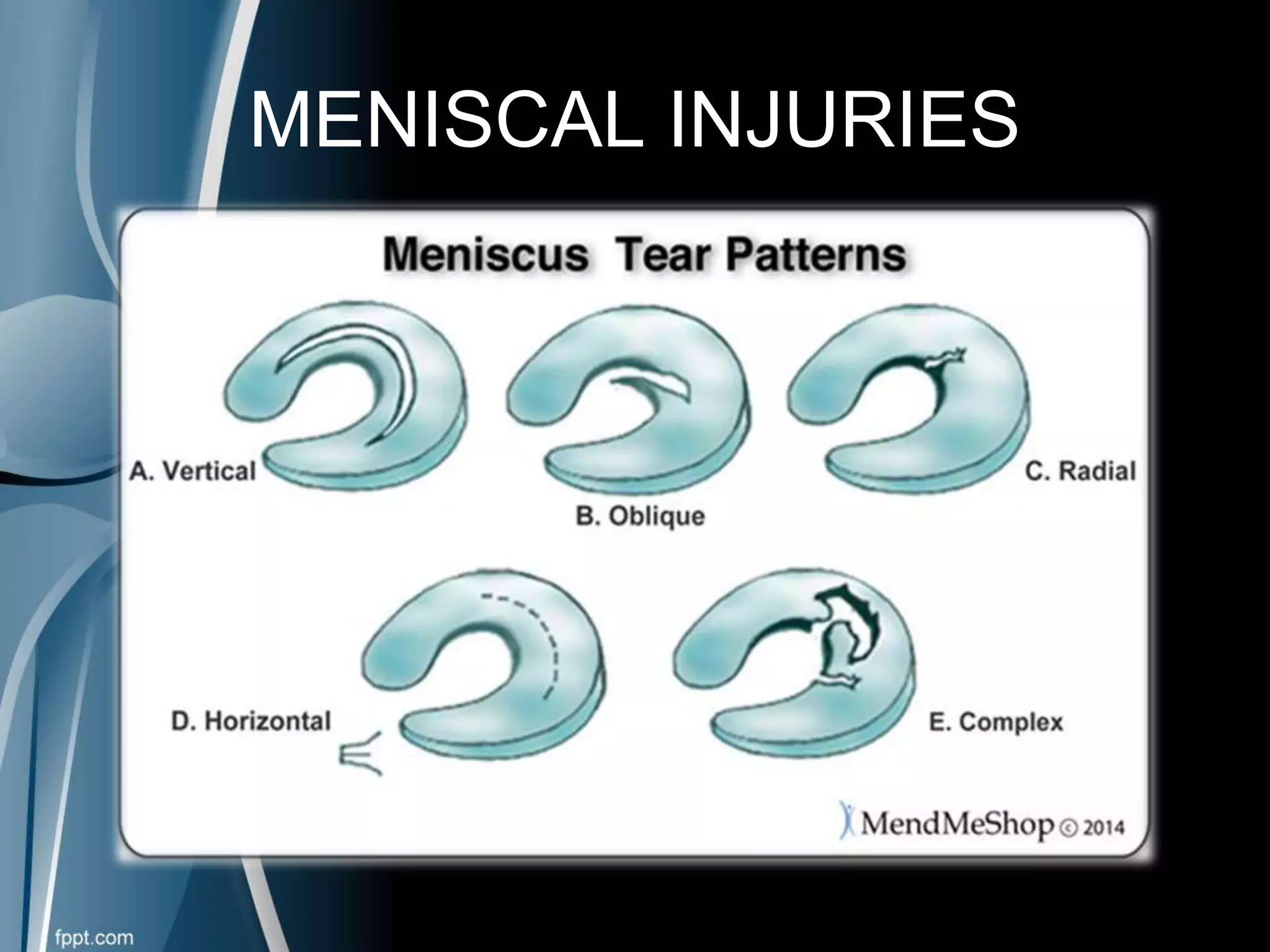 Meniscal Injuries | PPTX