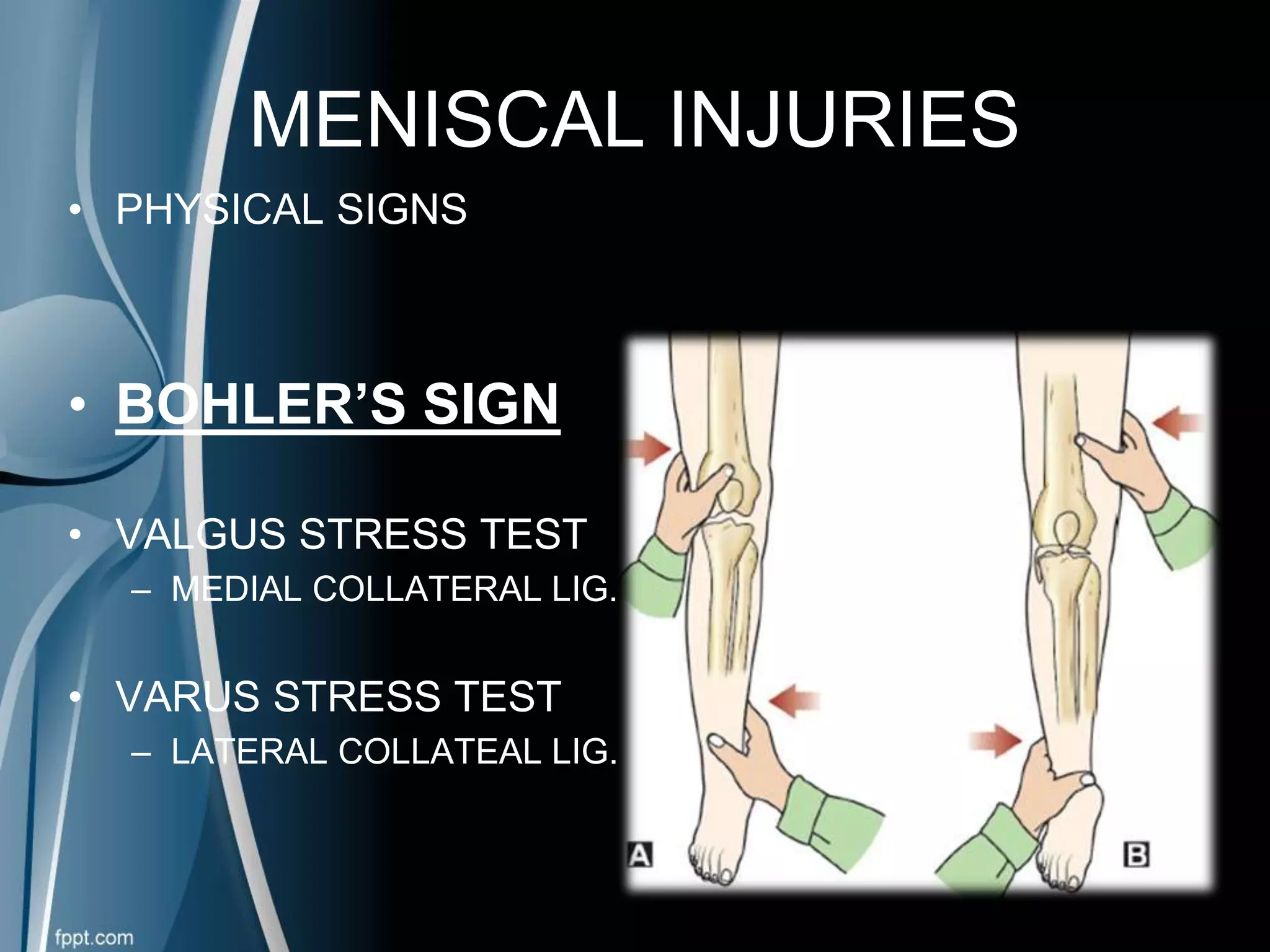 Meniscal Injuries | PPTX