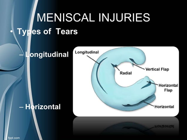 Meniscal Injuries | PPTX | Death, Injury, or Military Conflict ...