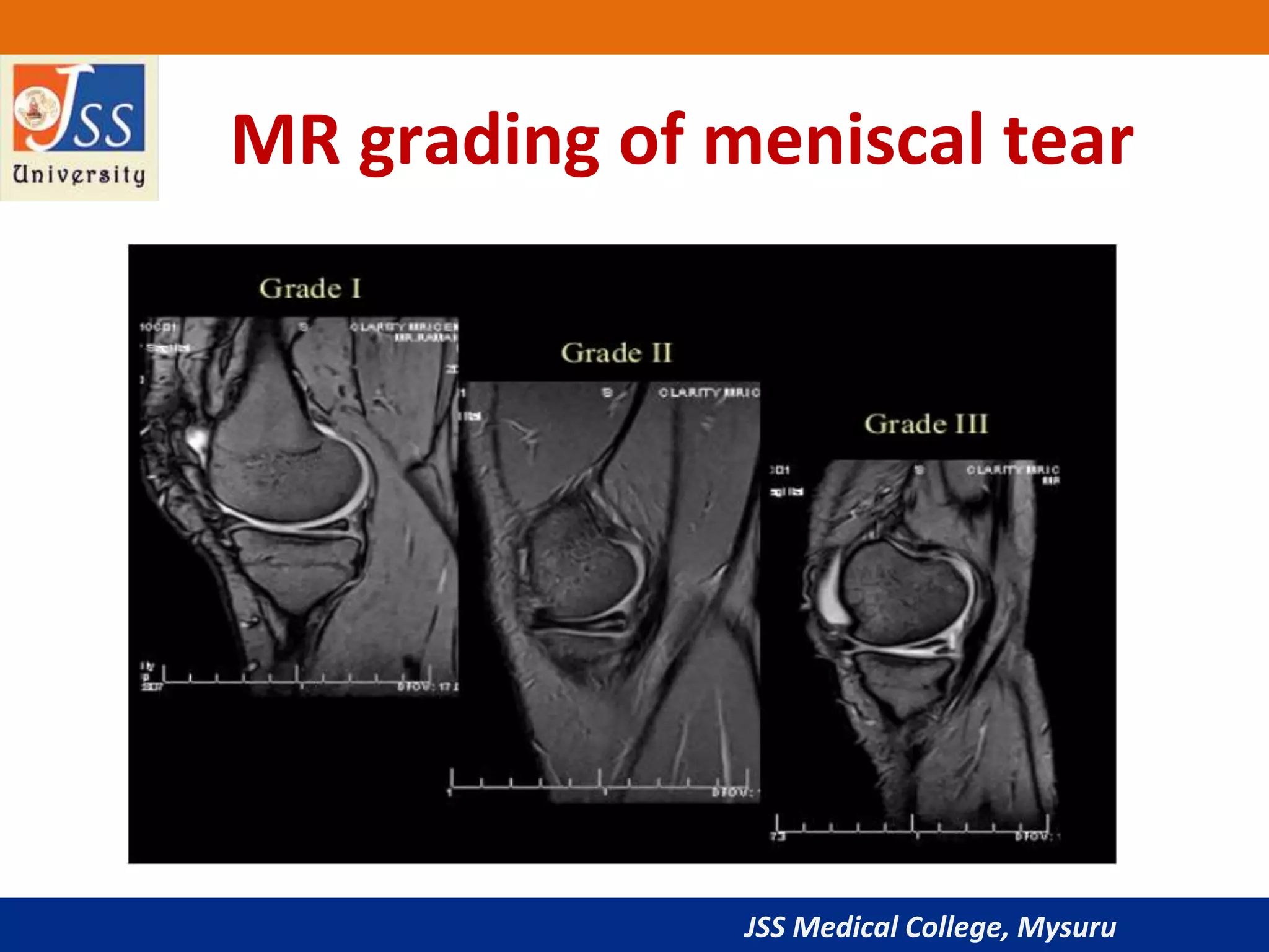 MRI KNEE.pptx