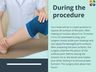 Eva Hospital - Know Some Facts About Knee Repalcement | PDF