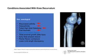 KNEE REPLACEMENT IN RECURVATUM KNEE.pptx
