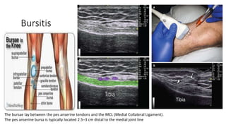 Knee Ultrasound and its use in Chronic Pain management.pptx